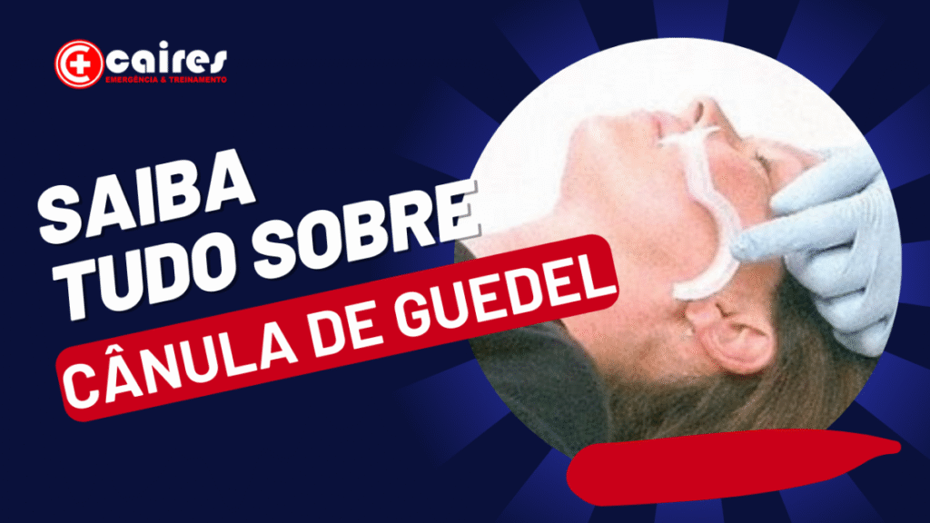 SAIBA TUDO SOBRE A CÂNULA DE GUEDEL